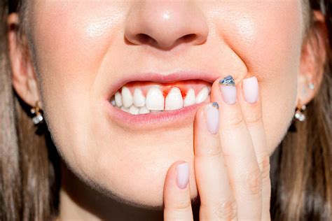 Tips To Prevent Gum Disease Dental Services Columbia Md