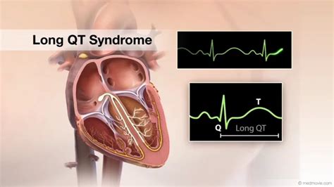 Qt Prolongation Of The Heart