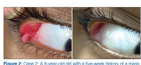 Pyogenic Granuloma Eye Treatment