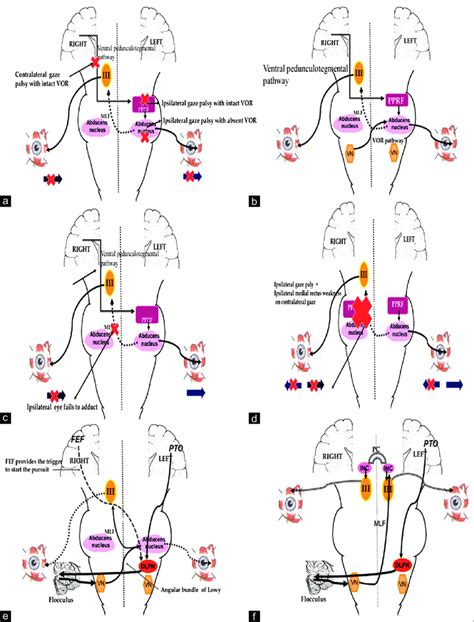 A Sites Of Lesions Causing Gaze Palsy B Vestibulo Ocular Reflex