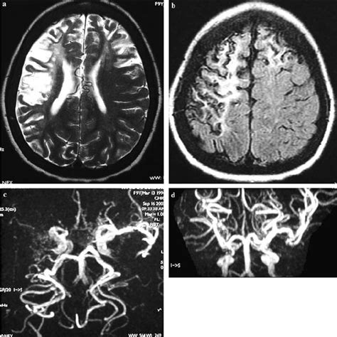 Normal Tcdi Elec Tronic Measurement Of The Left Mca Waveform