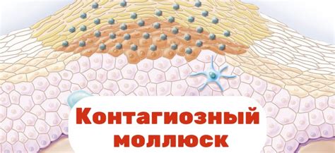 Контагиозный моллюск у детей и взрослых симптомы и лечение