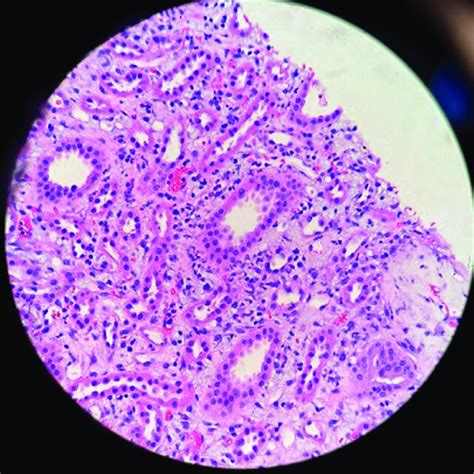 H And E Photomicrograph Showing Mild Edema And Focal Inflammatory