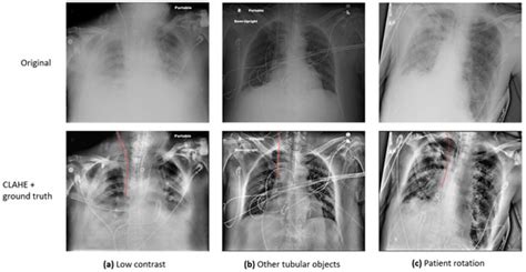Anatomically Guided Deep Learning System For Right Internal Jugular