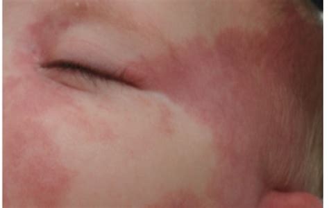 What Do Red Spots On Skin Mean Findatopdoc