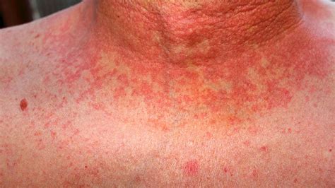 Scarlet Fever Signs Symptoms And Treatment