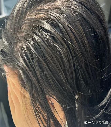 头发脱的发缝比海宽！女生脱发到底该怎么办？真的没法救了吗？ 知乎