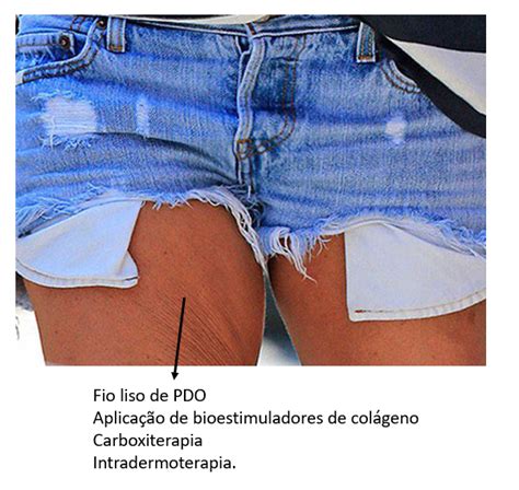 Flacidez Nas Coxas ClÍnica Bella Pelle