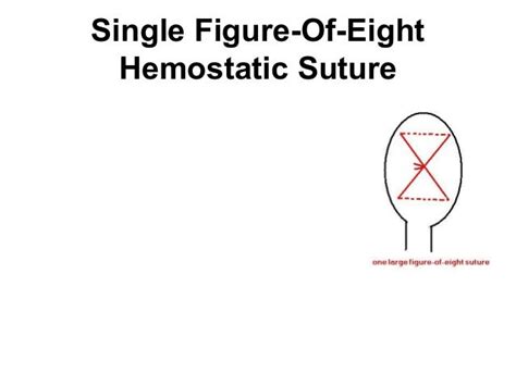 Uterine Compression Sutures