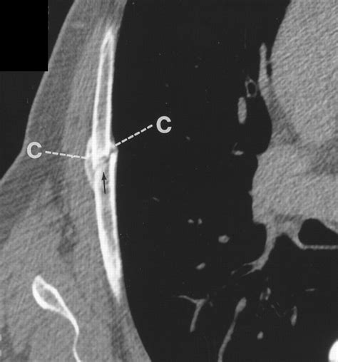 Rib Fracture On Ct Scan At Alica Martel Blog