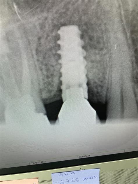 Dental Implant Infection Rdentalschool