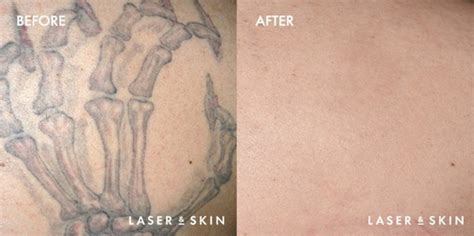 Laser And Skin Surgery Treatments Sacramento Northern California