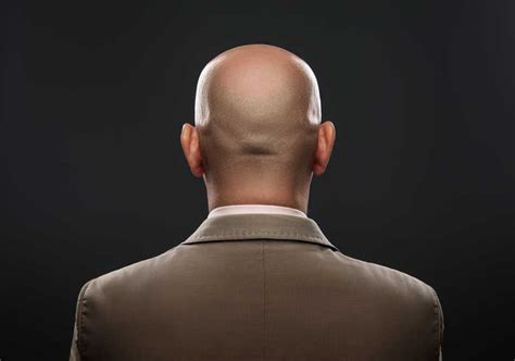 Penyebab Stigmatisasi Orang Botak