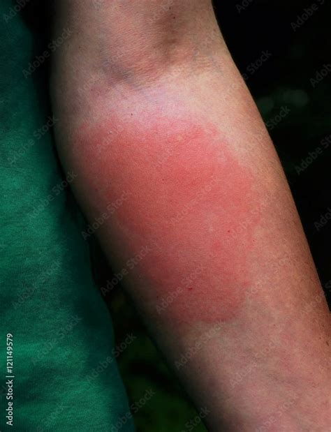 Normal Wasp Sting Reaction