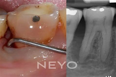 Periodontal Regeneration Restores Lost Gum Tissue