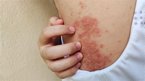 Adbry Vs Dupixent 5 Differences You Should Know For Eczema Goodrx
