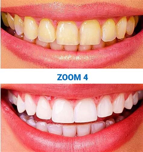 Отбеливание зубов Zoom 3 и Zoom 4 Дента Смайл