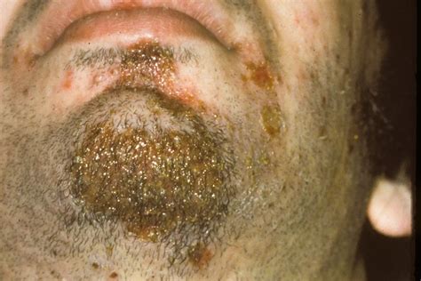 Neck Rash Causes And How To Treat And Prevent It