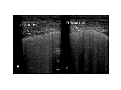 Lung Ultrasound Pdf
