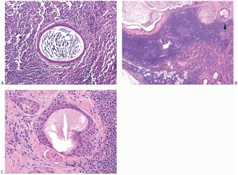 Squamous Carcinoma Basicmedical Key