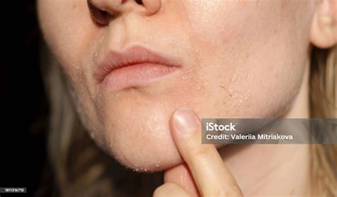 여자의 피부가 입에서 벗겨진다 건성 피부 필링 후 춥고 바람이 많이 부는 날씨 후에 피부 자극을 받으십시오 어두운 배경 프로필별