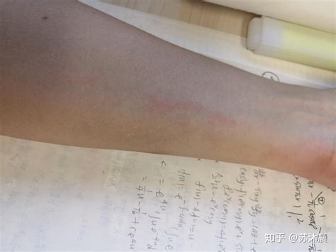 挑战荨麻疹 知乎