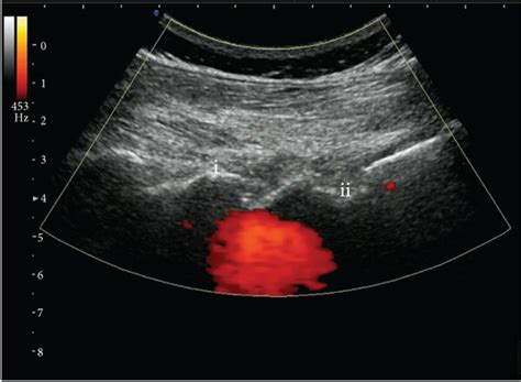 Ultrasound‐guided Transforaminal Injections Of Platelet‐rich Plasma