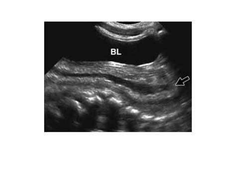 Abdominal Distension In Neonates Part 2pptx