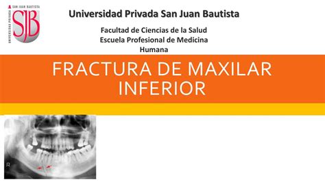 Fractura De Maxilar Inferior Luz Paguada Ruiz Udocz