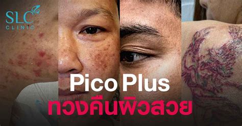 Pico Plus Laser ทวงคืนผิวสวย รักษาหลุมสิว รอยสิว ฝ้า รอยสัก ผิวไม่
