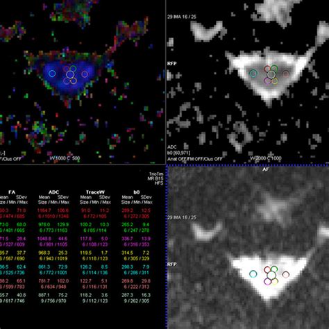 Fa Map And Corresponding Adc Map And B0 Image Showing Rois Placed In