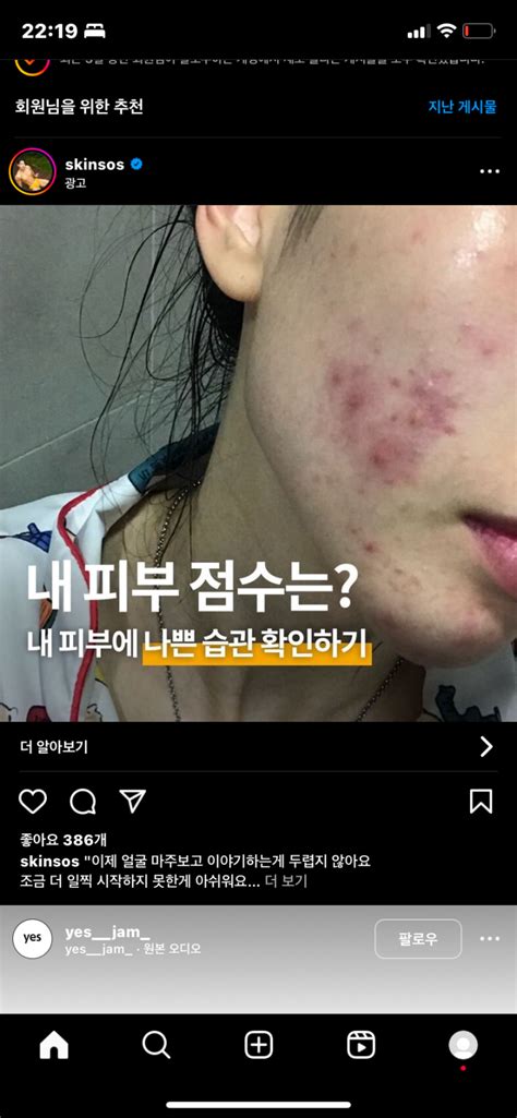 여드름 피부 관리 지식in
