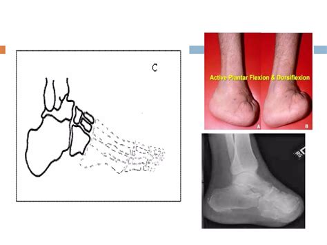 Prosthetic Management Of Symes And Partial Foot Amputation Ppt