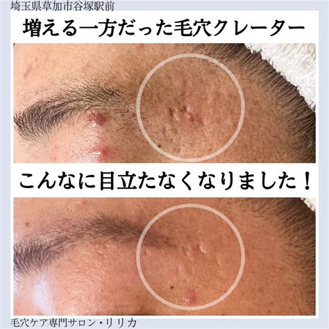 メンズ毛穴ケア1周年 埼玉東京 毛穴のひらき・黒ずみ・角栓つまり・ニキビ跡に特化