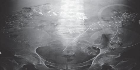 Indian Journal Of Nephrology