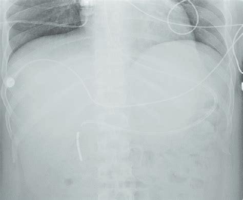 C Ppf In Post Pyloric Position Using Drx Revolution Mobile X Ray