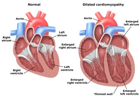 Ischemic Ischemic Heart Disease Pathophysiology