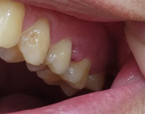 잇몸 사이 혹 지식in