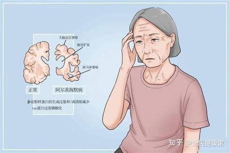 福丽康欣美金刚治疗老年性痴呆症效果好吗？吃和不吃的有区别吗？ 知乎