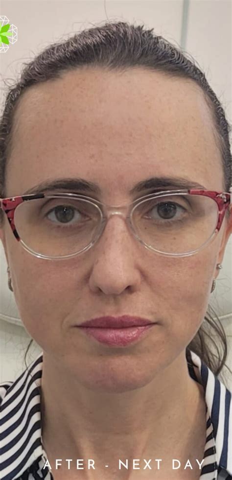 Next Day Pdo Threads Diamond Works Medspa