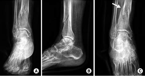 Spiral Fracture Tibia