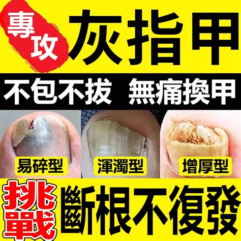 💥【優選精品灰甲專家】💥日本監製灰指甲修復液甲板萎縮改善手指變色甲溝炎指甲保養灰甲護理壞甲空甲草本去灰甲修復液 蝦皮購物