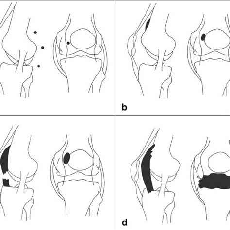 X Classification System For Ho Of The Knee Joint A Grade 1 Ho B Grade