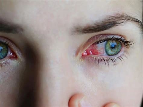 Conjuntivitis Qué Es Causas Síntomas E Información 47 Off