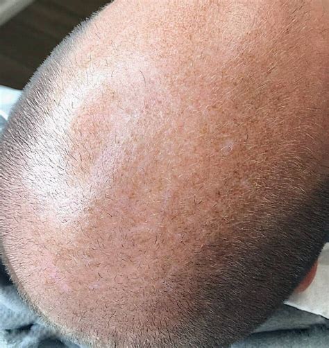 Beard Micropigmentation Painless Solution For Uneven Stubble