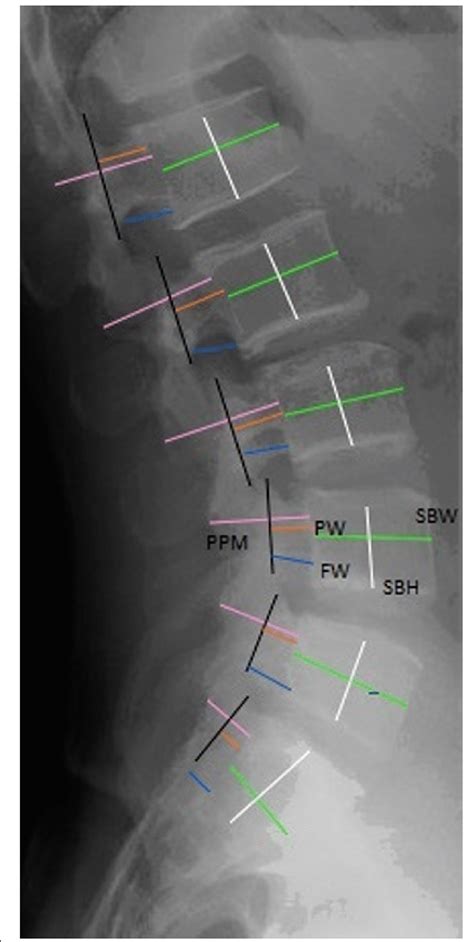 Measurement Scheme For The Lateral Standing Radiograph Sagittal