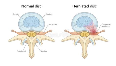 Nerve Root Stock Illustrations 1638 Nerve Root Stock Illustrations