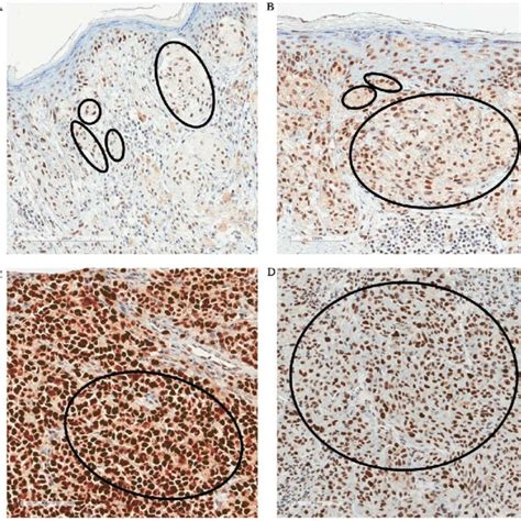 C Myc Protein Expression In Cutaneous Melanoma Representative Images