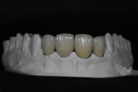 Refractory Feldspathic Veneers Traditional Vs Digital Workflow