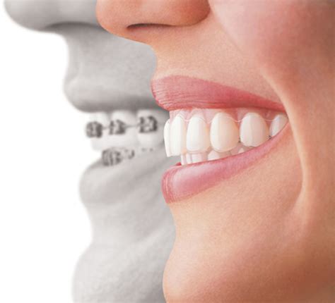 Royal Bahrain Hospital Invisible Braces More Than Just Aligners